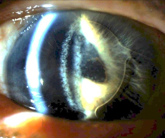 Is UGH syndrome still relevant in 2020? - eyeonoptics