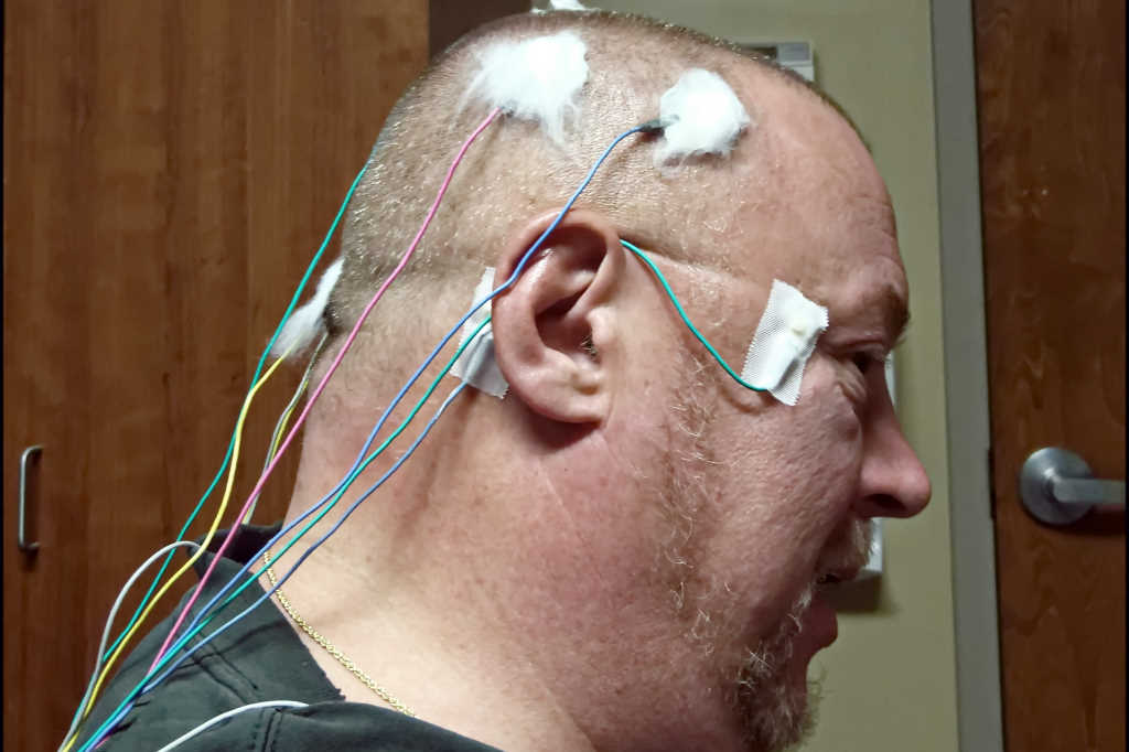 Electrical stimulation reduces CBS hallucinations - nzoptics