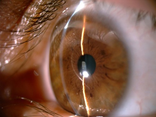 Unravelling the mystery of corneal peripheral thinning disorders - nzoptics