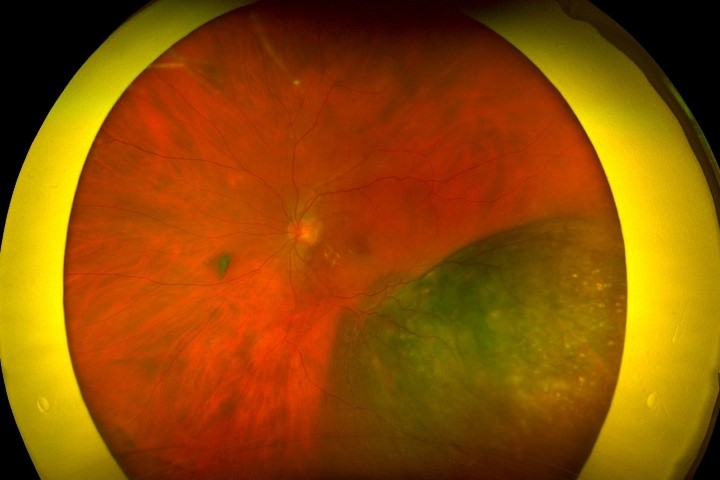 Retinal research and uveal melanoma - nzoptics