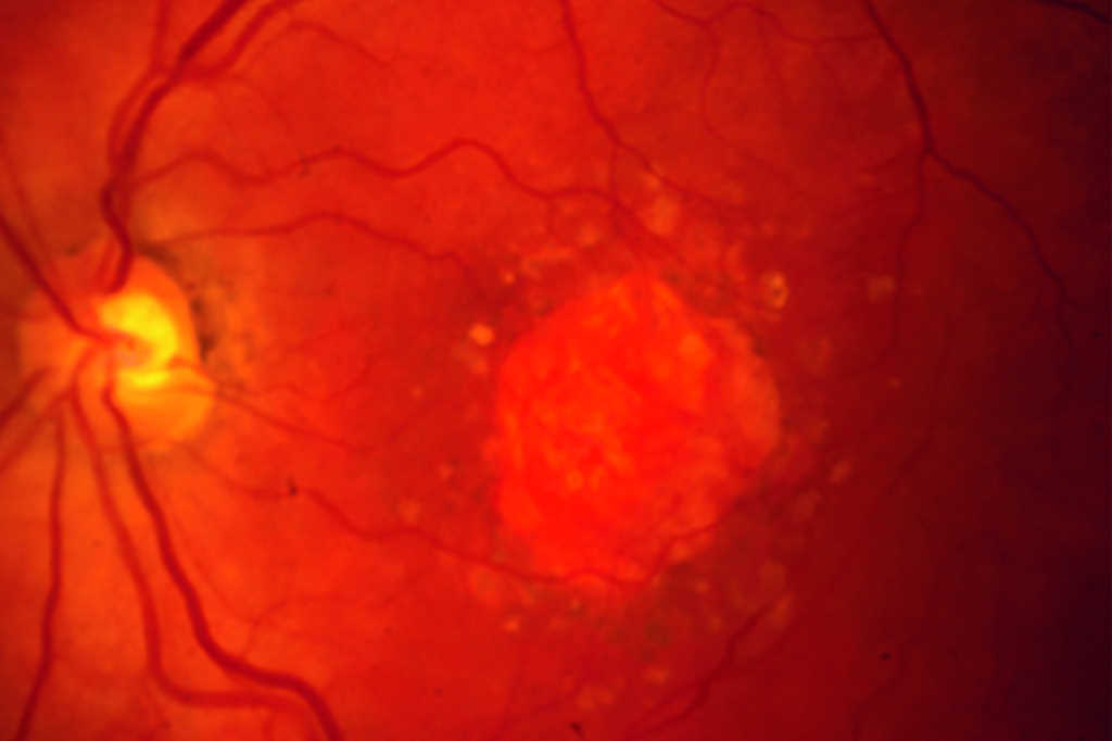 Validation of vision-sparing GA drug